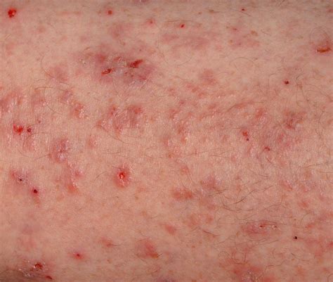The Scabies Rash And Other Scabies Symptoms Riverchase