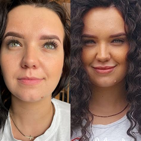 👇efekty Modelowania Ust Kwasem Hialuronowym👇 Nasza Klientka Kala