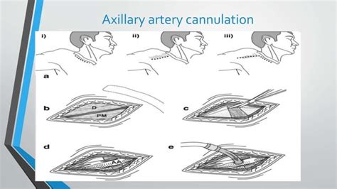 Cannulation For Ecmo Pptx