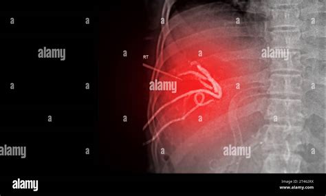 Percutaneous Transhepatic Biliary Drainage Ptbd Is A Medical