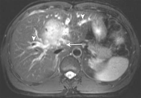 Cholangiocarcinoma Current And Novel Imaging Techniques Radiographics Cholangiocarcinoma Current And Novel Imaging Techniques Radiographics