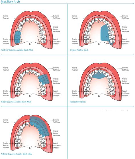 Dental Anesthesia Mandibular Anesthesia Gowgates