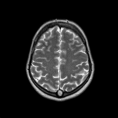 Arachnoid Granulation Pacs