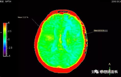 “穷人”的分子影像学——apt 知乎