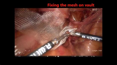 Laparoscopic Pectopexy Youtube