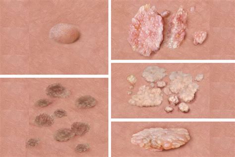 Cauterization Procedures Obstetrician And Gynecologist Cauterization Procedures Obstetrician And Gynecologist