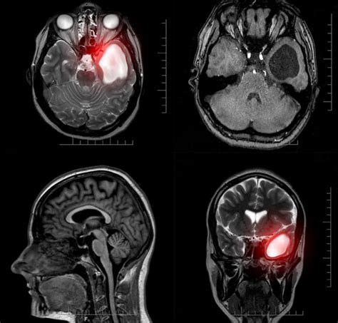 Arachnoid Cyst Diagnosis