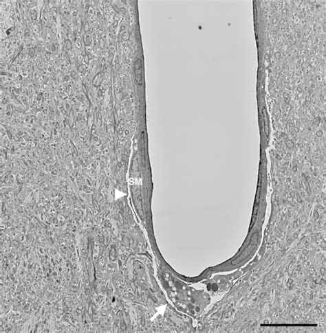 Chronic Pathology In A Penetrating Cortical Vessel Following Blast Download Scientific Diagram