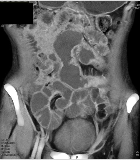 Thickening Small Bowel Due To Infectious Enteritis Small Bowel