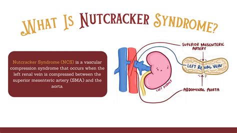 Renal Nutcracker Syndrome Presentation Et Ppt