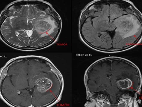 გლიალური სიმსივნეები ძვლის თავის ტვინის სიმსივნეები მეტასტაზი