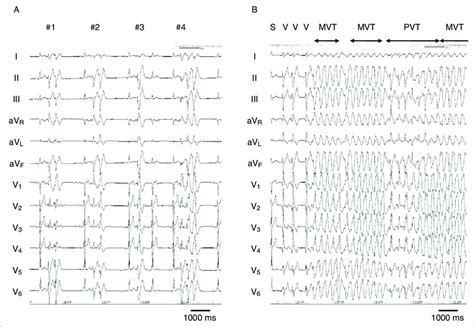 Different Types Of Pvc Rhythm At Harrison Humphries Blog