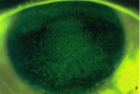 Fluorescein Staining Diagnostic Patterns Flashcards Easy Notecards