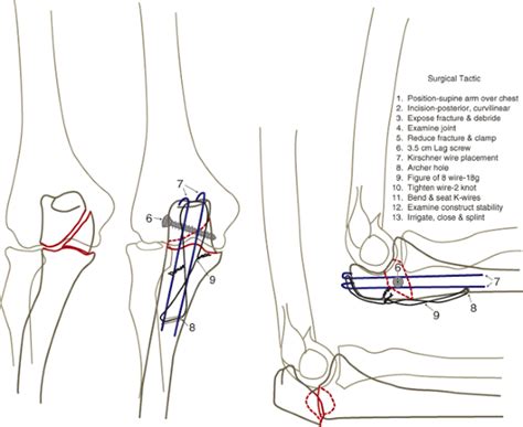 Olecranon Fractures Open Reduction Internal Fixation Teachme Orthopedics