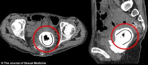 Sex Toy Discovered In Woman S Vagina Had Been There For YEARS Daily Mail Online