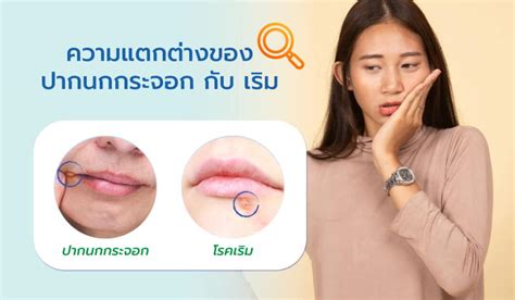 ปากนกกระจอก เกิดจากอะไร รักษาอย่างไร กี่วันหาย [อัปเดต 2024]