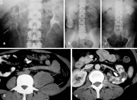 Ae Renal Tb A An Ivu Film Demonstrates Dystrophic Parenchymal