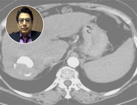 Combination Therapy With Tace And Microwave Ablation To Increase Efficacy Of Hepatocellular