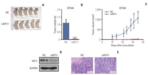Kif11 Functions As An Oncogene And Is Associated With Poor Outcomes