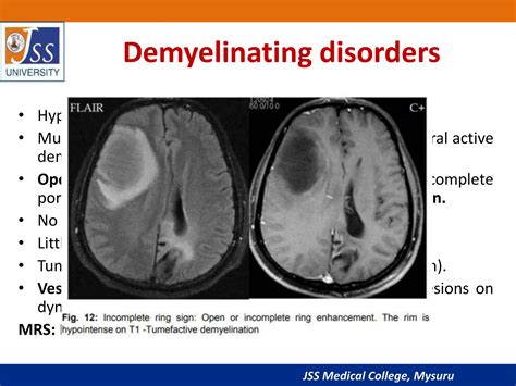 Ring Enhancing Lesions¹111222222222111112 Ppt