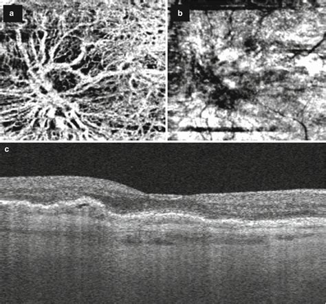 Swept Source Optical Coherence Tomography Ento Key