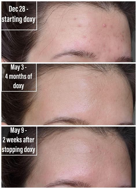 [review] Doxycycline Short Lived Success R Skincareaddiction