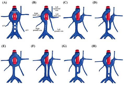 Drawings Of Renal Vein Development Modified From 24 Circumaortic