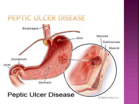 Peptic Ulcer Disease Pptx