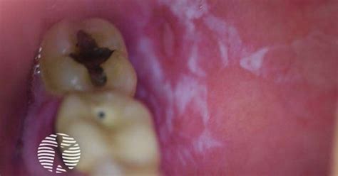 Oral Lichen Planus Reticular Pattern Image