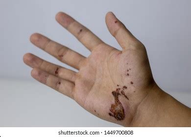 Scabs Images Stock Photos Vectors Shutterstock