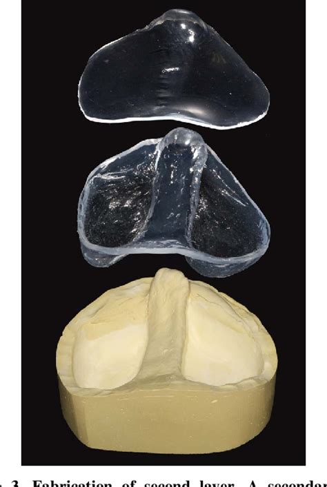 Figure 3 From Effectiveness Of A Custom Made Temporary Obturator After Bilateral Total