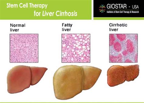 Stem Cell Therapy For Liver Cancer In India Cancerwalls