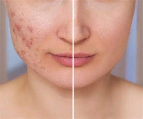 Acne Scar Removal Treatment Sculpturehealthcare