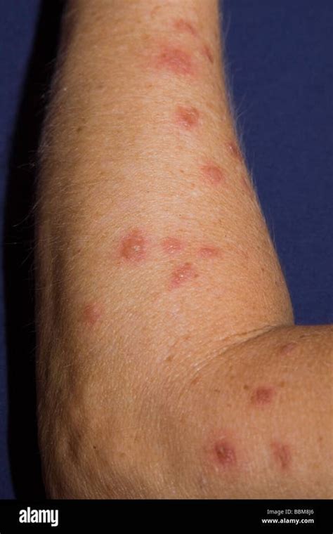 Red Bumps On Arms Not Itchy Red Bumps On Arms Not Itchy