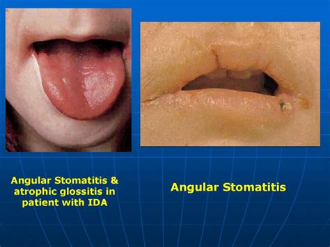 Mouth And Salivary Glands Ppt Download