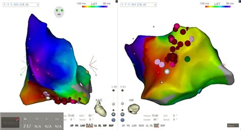 Atrial Flutter — Diagnosis Management And Treatment Intechopen
