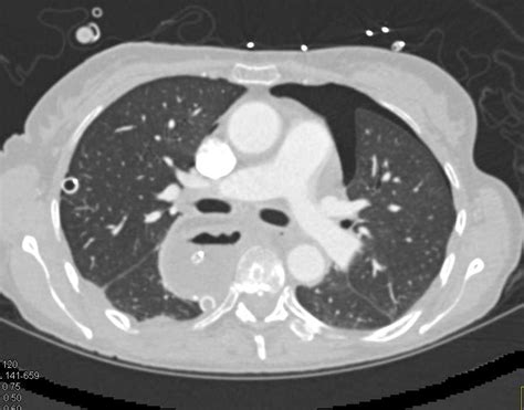 Esophageal Gist Tumor Esophagus Case Studies Ctisus Ct Scanning
