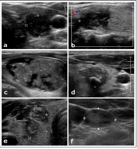Figure 4 From Reliability Of The Ultrasound Classification System Of