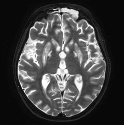 Patient 2—transverse Section Of Mri T2 Weighted Sequences Documenting Download Scientific