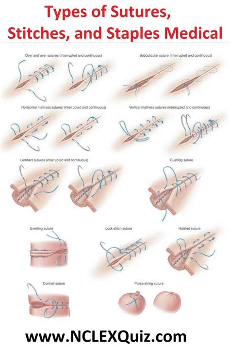 Types Of Sutures Stitches And Staples Medical Types Of Sutures And Stitches Su Medical
