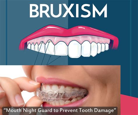 Bruxism буюу шүд хавирах эмгэг гэж Маюми шүдний эмнэлэг