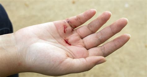 Symptoms Of Tetanus Facty Health