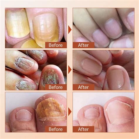 손발톱 곰팡이 치료 펜 손발톱 진균증 감염 방지 발가락 손톱 곰팡이 복구 세럼 손 발 미용 건강 관리 네일 아트 및 도구