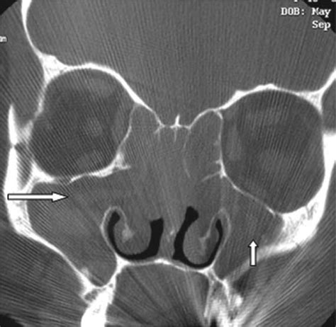 Frontoethmoidal Mucocele Ento Key