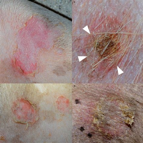 Canine Epidermal Collarettes Clinical Lesions Acd Annular To