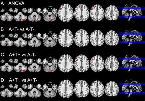 Frontiers The Abnormal Accumulation Of Pathological Proteins And Compensatory Functional