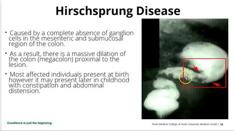 Multifactorial Inheritance T0 0177 Youtube