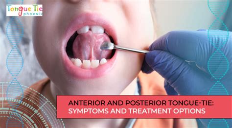 Tongue Tie Test Signs Diagnosis And 7 Steps For Assessment