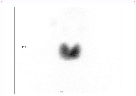 99mtc Pertechnetate Thyroid Scintigraphy Showing Enlarged Thyroid Gland Download Scientific