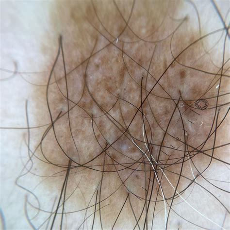 Dermoscopy Skin Cancer Dermatofibroma X Lichen Planus Courtesy Of Colleague Andrecapeletti